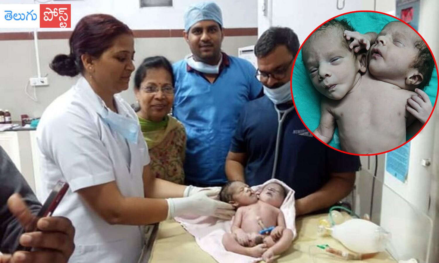 అరుదైన బిడ్డకు జన్మనిచ్చిన మహిళ.. రెండు తలల మధ్య నుంచి మూడో చేయి ...